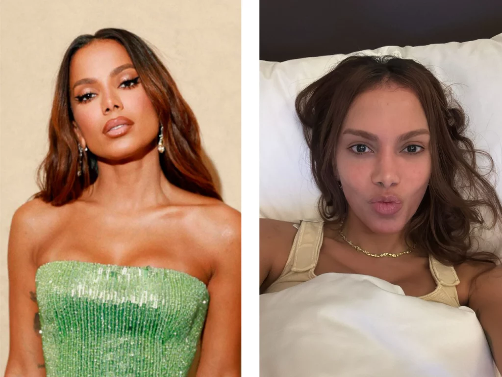 Rosto da Anitta: antes e depois surpreende fãs - VTV News | Notícias do ...